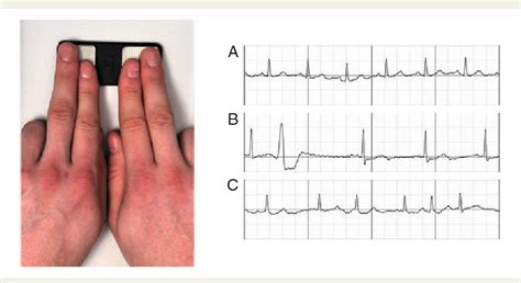 Figure 1 From Detection Of Atrial Fibrillation With A Smartphone Camera First Prospective