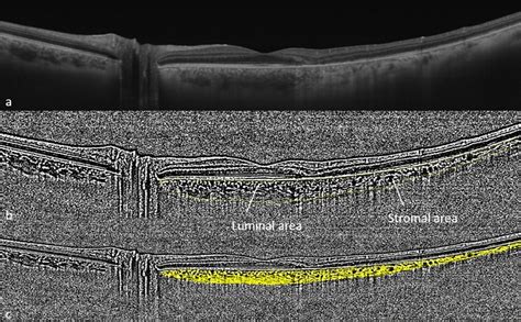 Calculation Of Choroidal Vascularity Index Cvi In A Patient With
