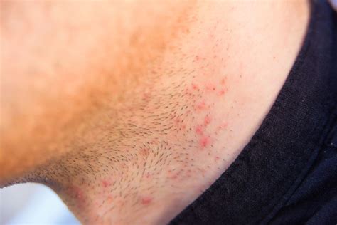 Ingrown Hair And Razor Bumps Laser Cosmetic Clinic