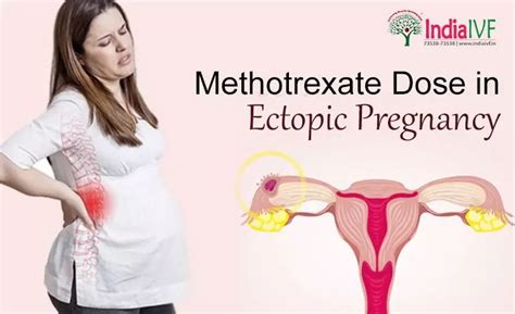 Methotrexate Dose In Ectopic Pregnancy India Ivf Fertility