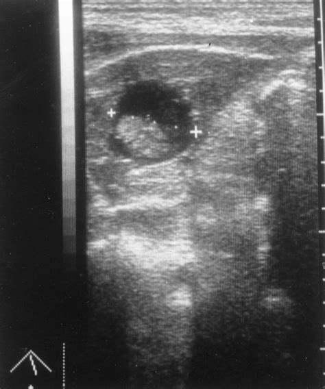 二肝内胆管囊样乳头状腺癌 临床超声诊断学 医学