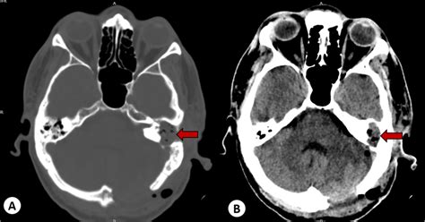 Head Ct Scan A Bone Window B Brain Window Showing The Presence Of Download Scientific
