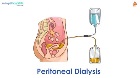 Peritoneal Dialysis Diagram