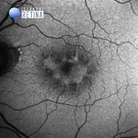64 Acquired Vitelliform Lesion In The Setting Of Age Related Macular