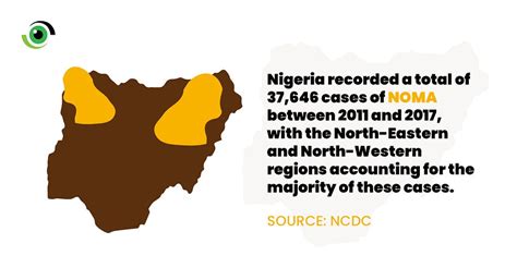Why We Must Accelerate The Inclusion Of Noma As A Neglected Tropical