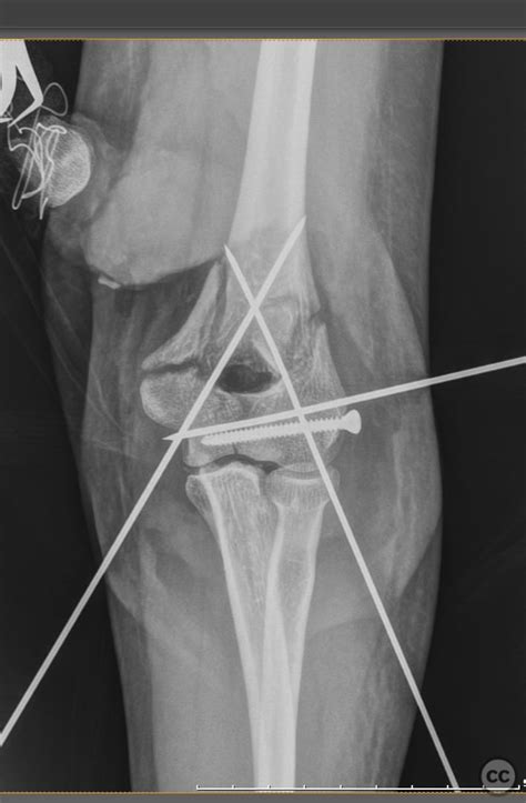 Displaced Intra Articular Distal Humerus Fracture With Olecranon Osteotomy