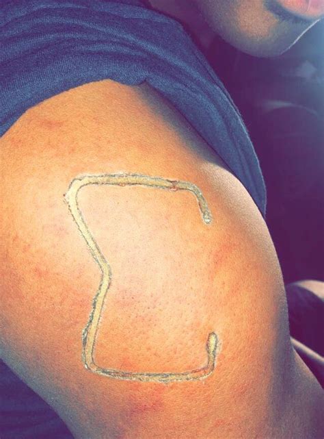 Healed Brand On Human Skin