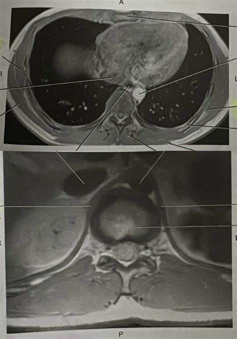 Unit 6 5 Cardiac Imaging Azygos Venous System Muscles And Breasts