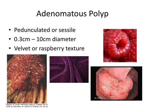 Ppt Neoplasia Of Colon Powerpoint Presentation Id2271883