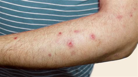 Causes And Treatment Of Pruritus Itchy Skin Uraemic Pruritus Renal