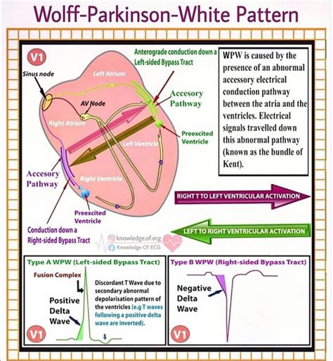 Wolff Parkinson White Wpw Syndrome Cardiac Nursing Nursing School Essential Cardiac Sonography