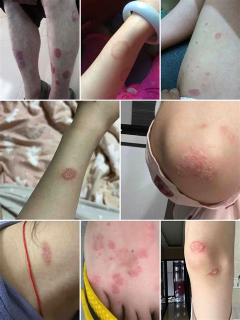 得了体癣赶快治，因为它真的会传染！ 知乎
