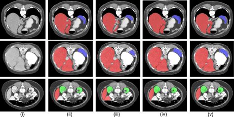 Figure 5 From Multi Organ Segmentation Over Partially Labeled Datasets