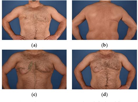 Figure 1 From Development Of A Surgical Treatment Algorithm For Breast