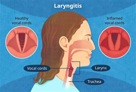 Tonsils Throat Diseases Laryngitis Symptoms Treatment Icon 52 Off