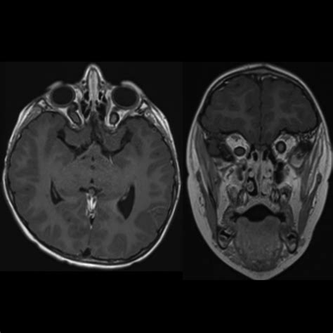 Pediatric Optic Pathway Glioma Pediatric Radiology Reference Article Pediatric Imaging