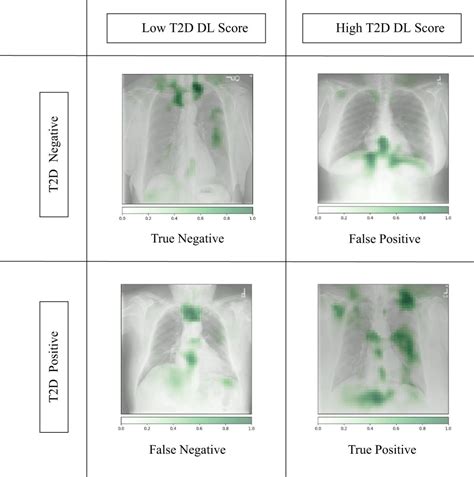 earlier detection of diabetes through chest x rays and ai healthcare
