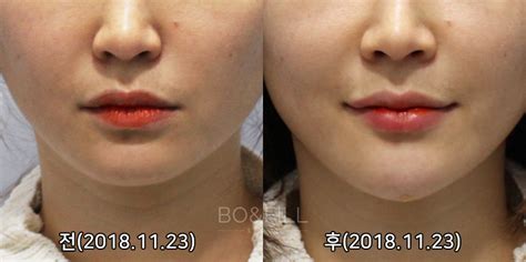턱끝필러and자갈턱보톡스입술필러and입꼬리보톡스 디에이치페이스업의원 The H Faceup Clinic Korea