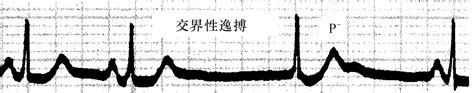 交界性逸搏逸搏心律 临床心电图