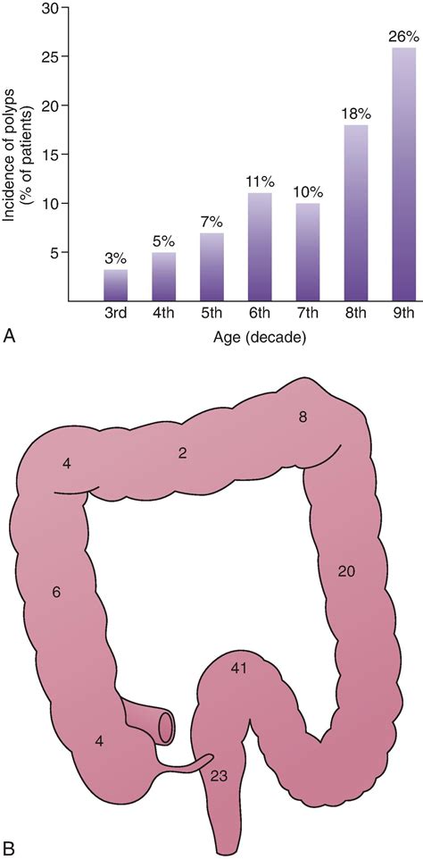 Polyps And Colon Cancer Clinical Tree