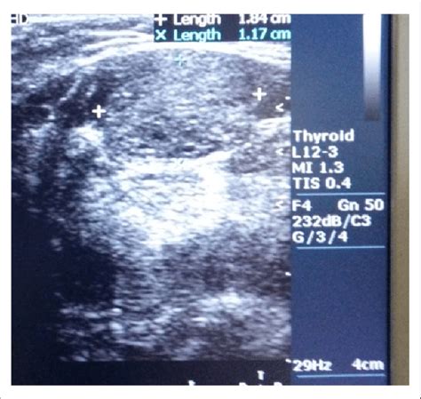 Ultrasonographic Appearance Of Submentally Located Ectopic Thyroid Download Scientific Diagram