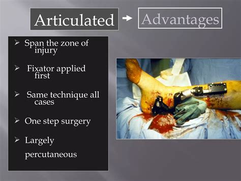 Lecture Ucmc Pilon Plafond Fracture Distal Tibia Ppt Death Injury