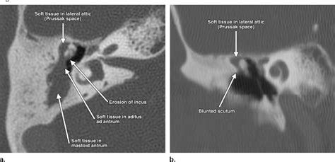 Scutum Temporal Bone