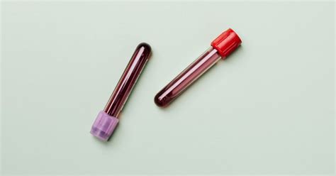 Kanser Limfoma Simptom Punca Faktor Risiko Dan Rawatan