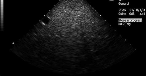 Acusonsiemens V5ms Cardiac Phased Array Probe Image Degradation