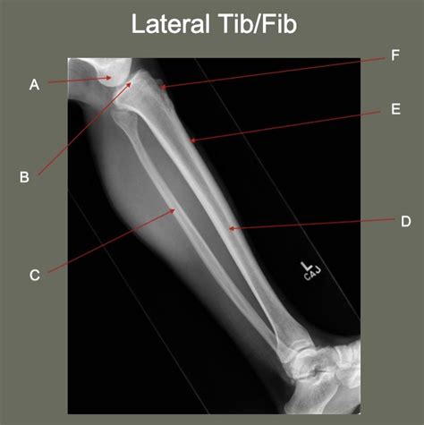 Tib Fib Lateral Diagram Quizlet