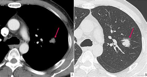放疗医生评估放疗计划中国专家共识 Csdn博客