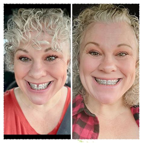 8 Month Progress Pics Rbraces