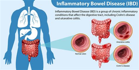 Inflammatory Bowel Disease