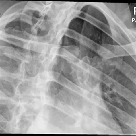 X Ray Left Sterno Clavicular Joint Pa Oblique Test Price In Delhi Ganesh Diagnostic