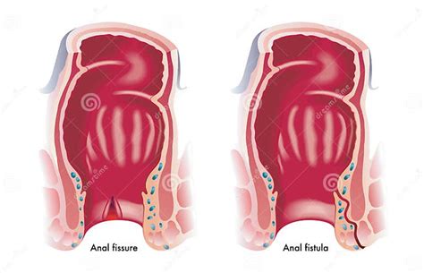Fissura Anal E Fístula Ilustração Do Vetor Ilustração De Sangramento