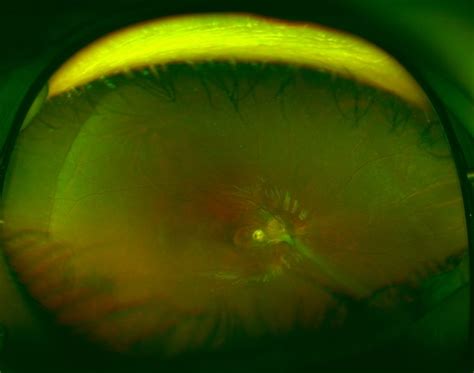 Unilateral Subretinal Toxocara Granuloma Retina Image Bank