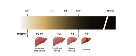 Core Concepts Evaluation And Staging Of Liver Fibrosis Evaluation Staging And Monitoring