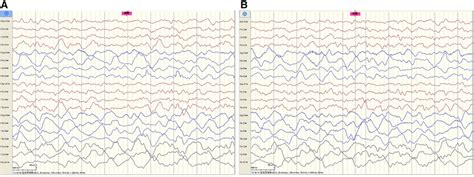 Video Eeg Monitoring Of Patient 1 Showed Persistent Asymmetry Between Download Scientific