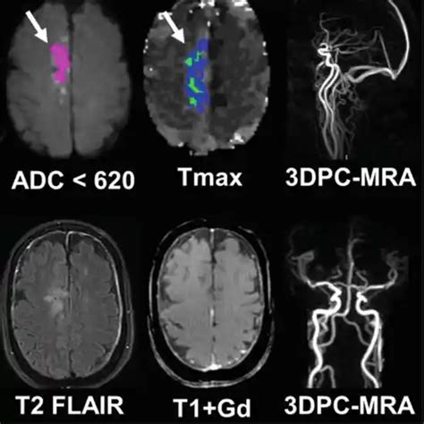 Mri Screening Of Brain Dwi Mra Neck Test Near You In Delhi Book