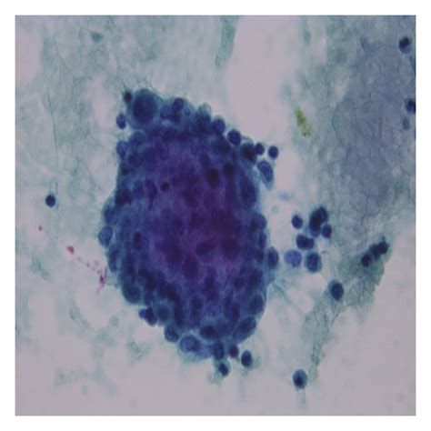 Pleural Fluid Cytology Pap Stain ×40 Mesothelial Cells With Download Scientific Diagram