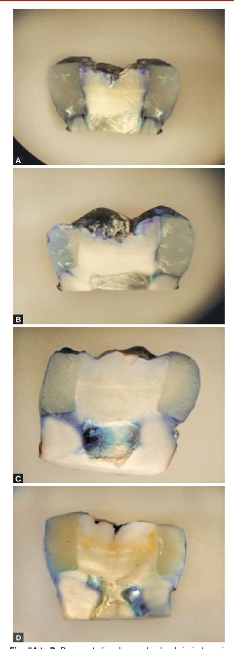 Figure 1 From Effect Of Four Different Placement Techniques On Marginal Microleakage In Class Ii