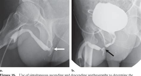 Figure 4 From Urethral Injuries After Pelvic Trauma Evaluation With