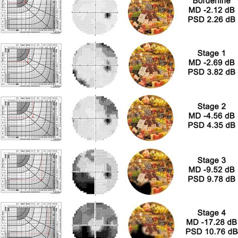Glaucoma Symptom Scale Gss Questionnaire Scores By Stage According To Download Scientific