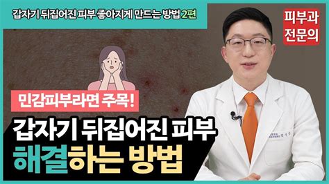 갑자기 뒤집어진 피부 해결방법 2편 Youtube