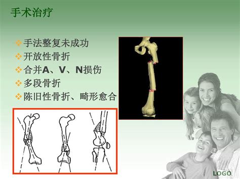 股骨干骨折的护理 ppt download