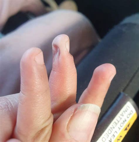 Potential Risks Of Finger Pinch Crush Or Shear Incidents