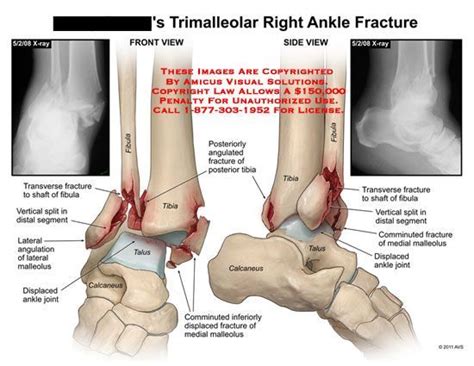 Trimalleolar Ankle Fracture Recovery