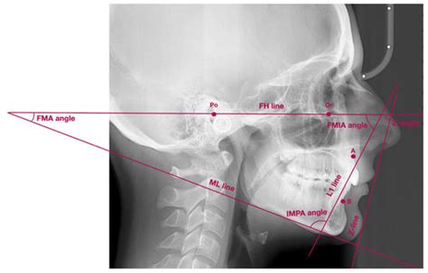 Personalized Orthodontics From The Sagittal Position Of Lower Incisors