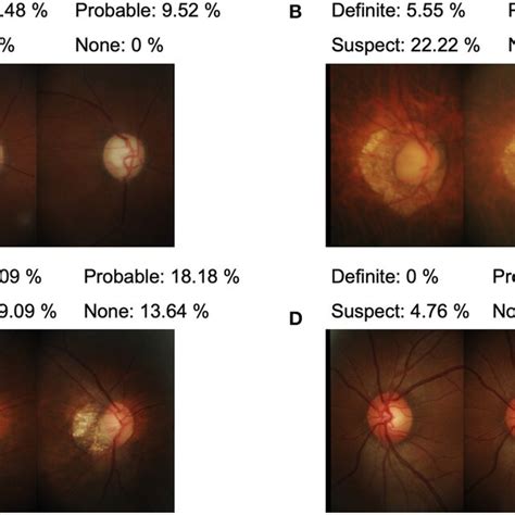 Examples Of Representative Optic Disc Photographs Of Various Glaucoma Download Scientific