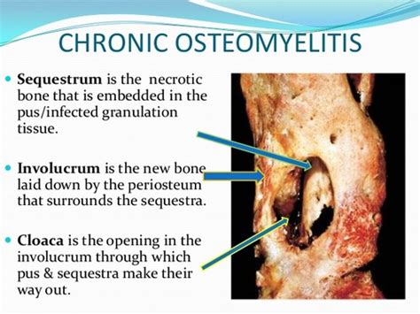 Bones Joints And Soft Tissue Tumors Robbins Chapter 26 Flashcards